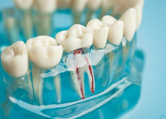 Root Canal Treatment: What to Expect & How It Saves Your Tooth